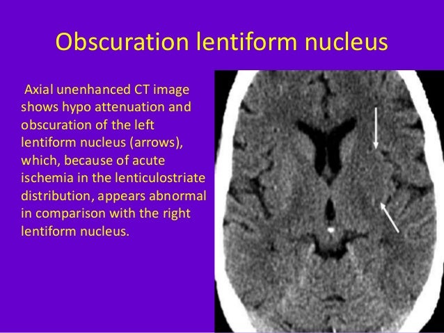 Imaging in acute stroke