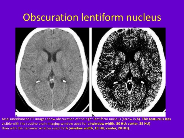 Imaging in acute stroke