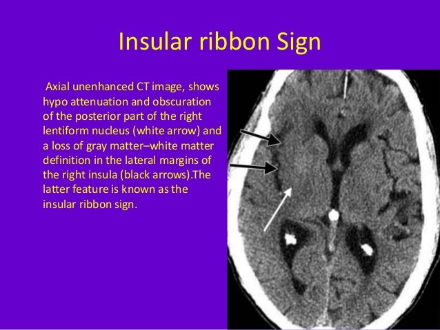 Imaging In Acute Stroke