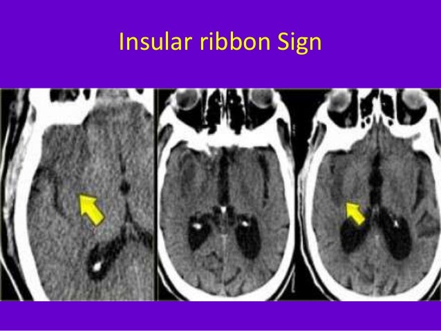 Imaging in acute stroke