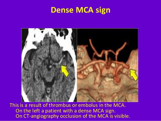 Imaging in acute stroke