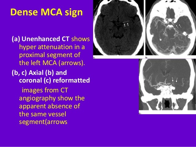Imaging in acute stroke
