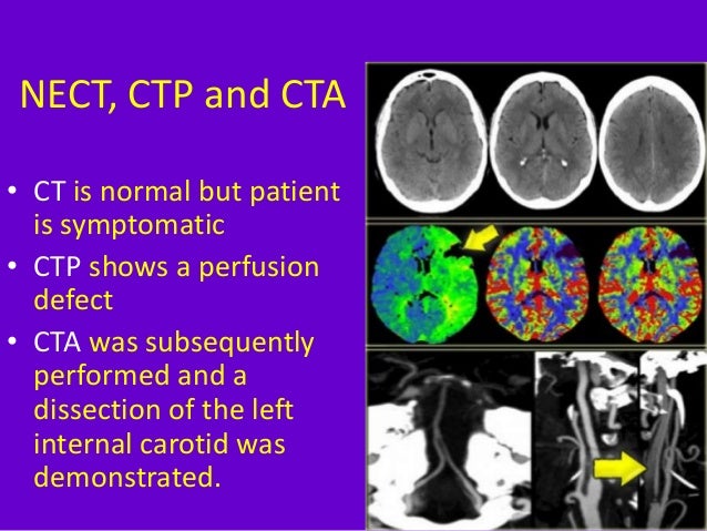 Imaging In Acute Stroke