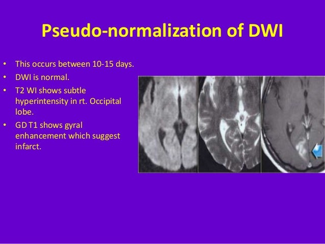 Imaging in acute stroke