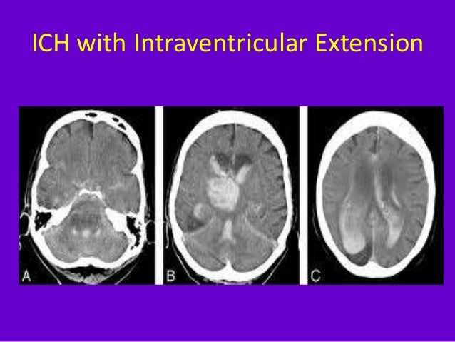 Imaging in acute stroke