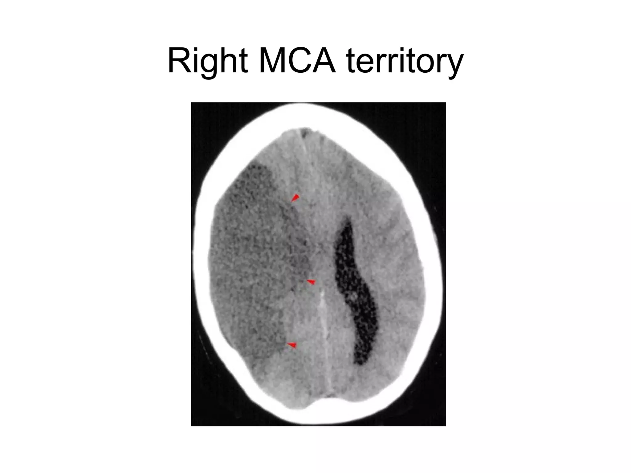 Imaging In Acute Stroke Ppt