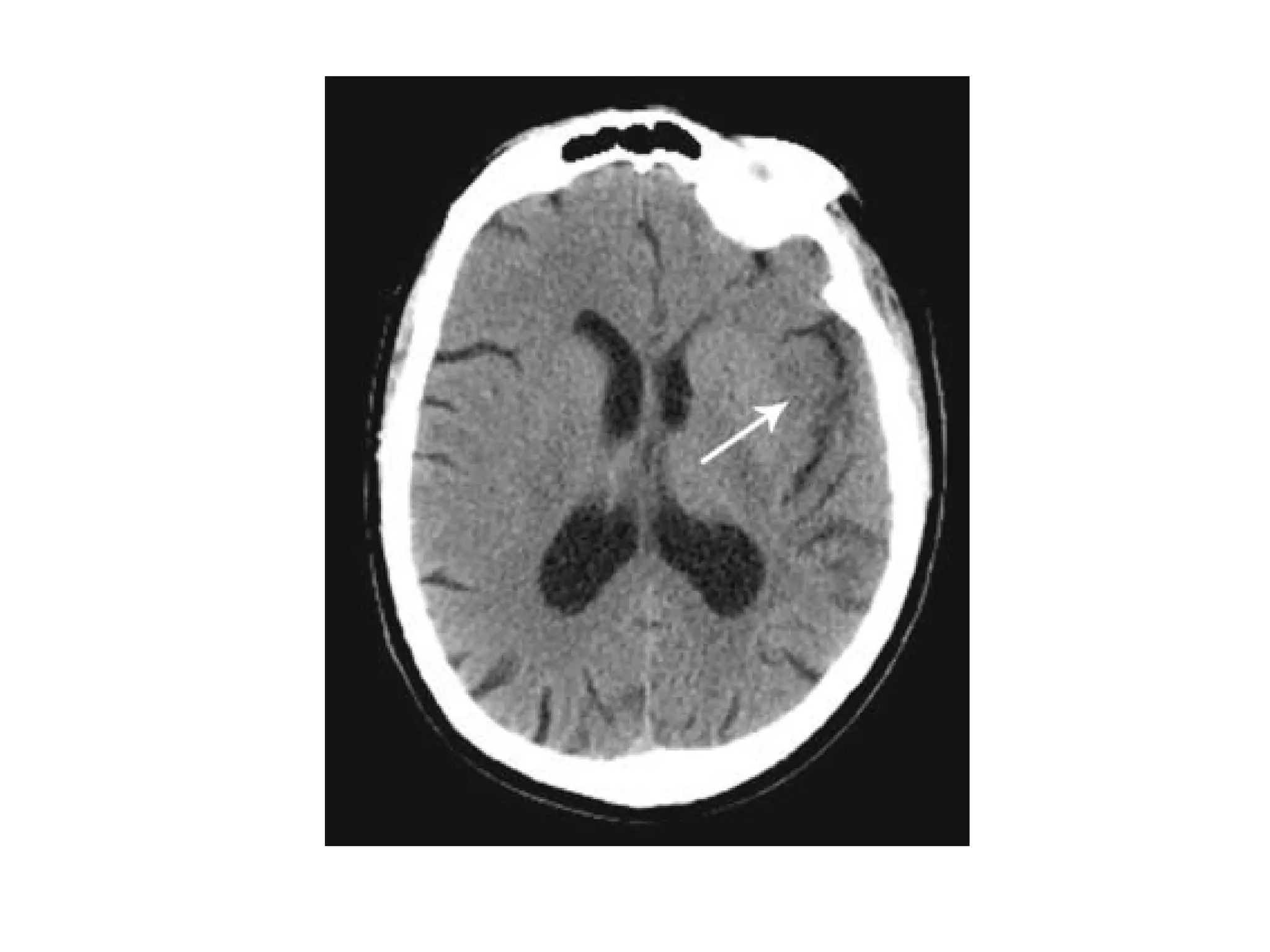 Imaging In Acute Stroke Ppt