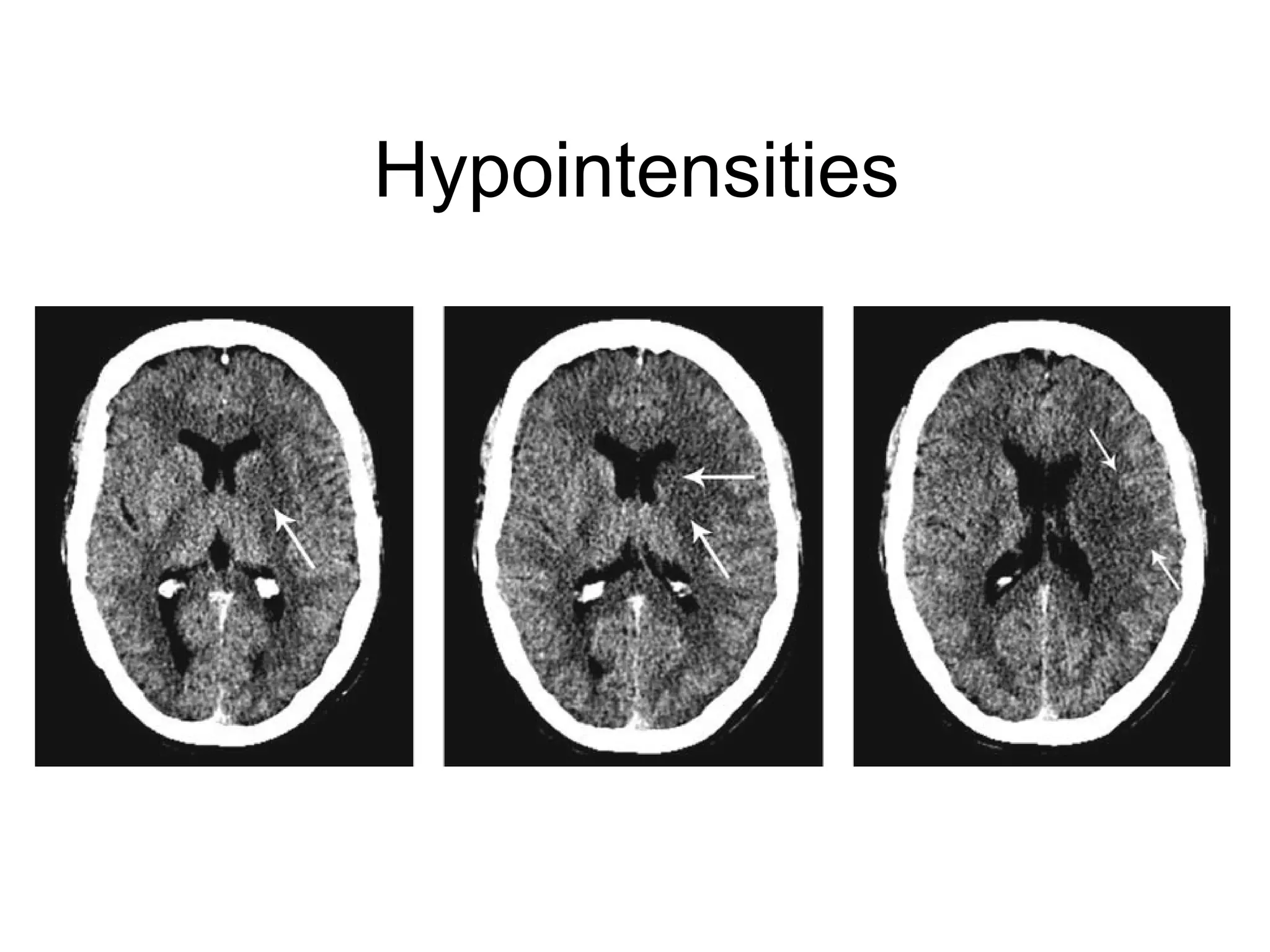 Imaging In Acute Stroke Ppt