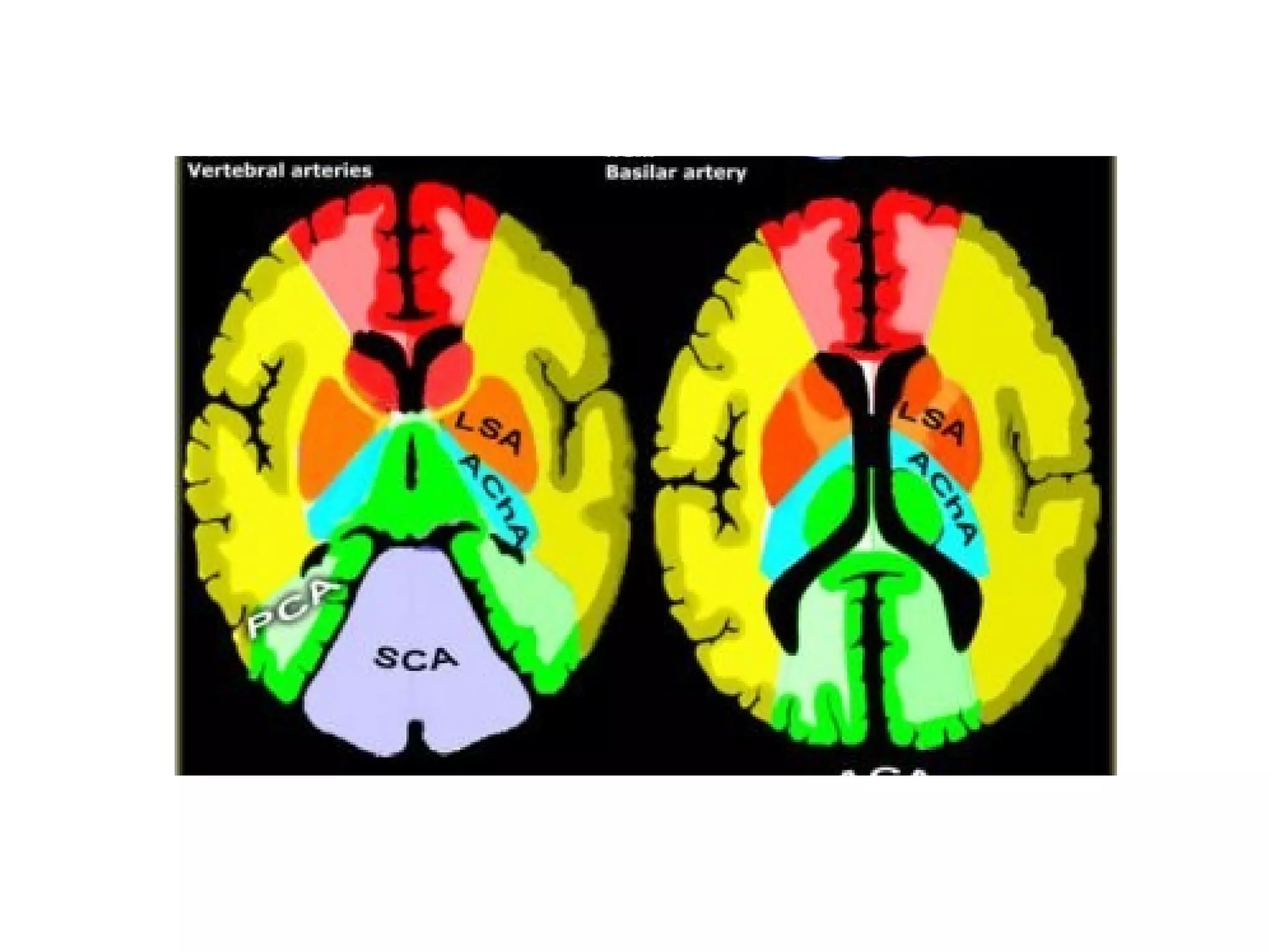 Imaging In Acute Stroke Ppt