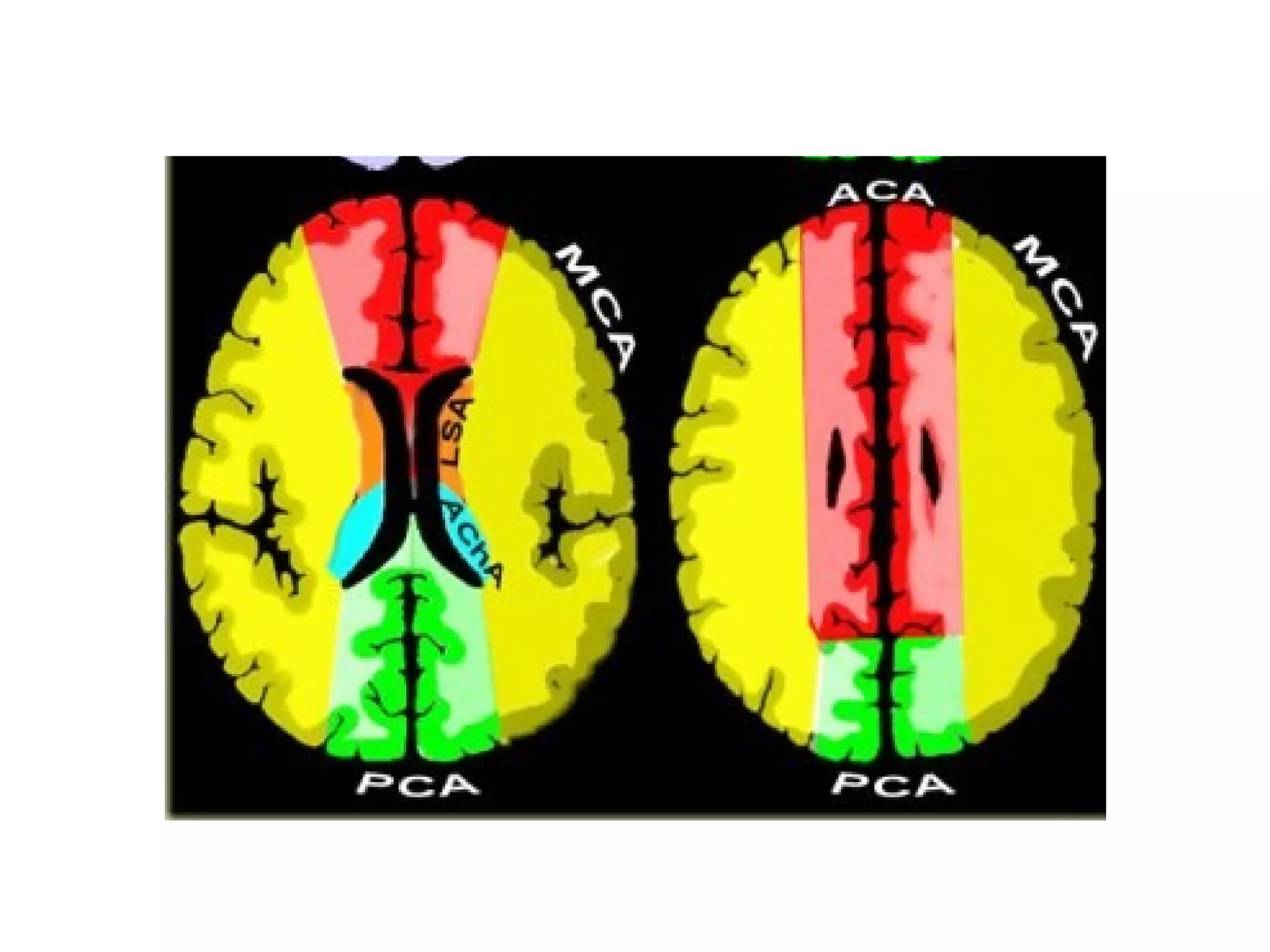 Imaging In Acute Stroke Ppt