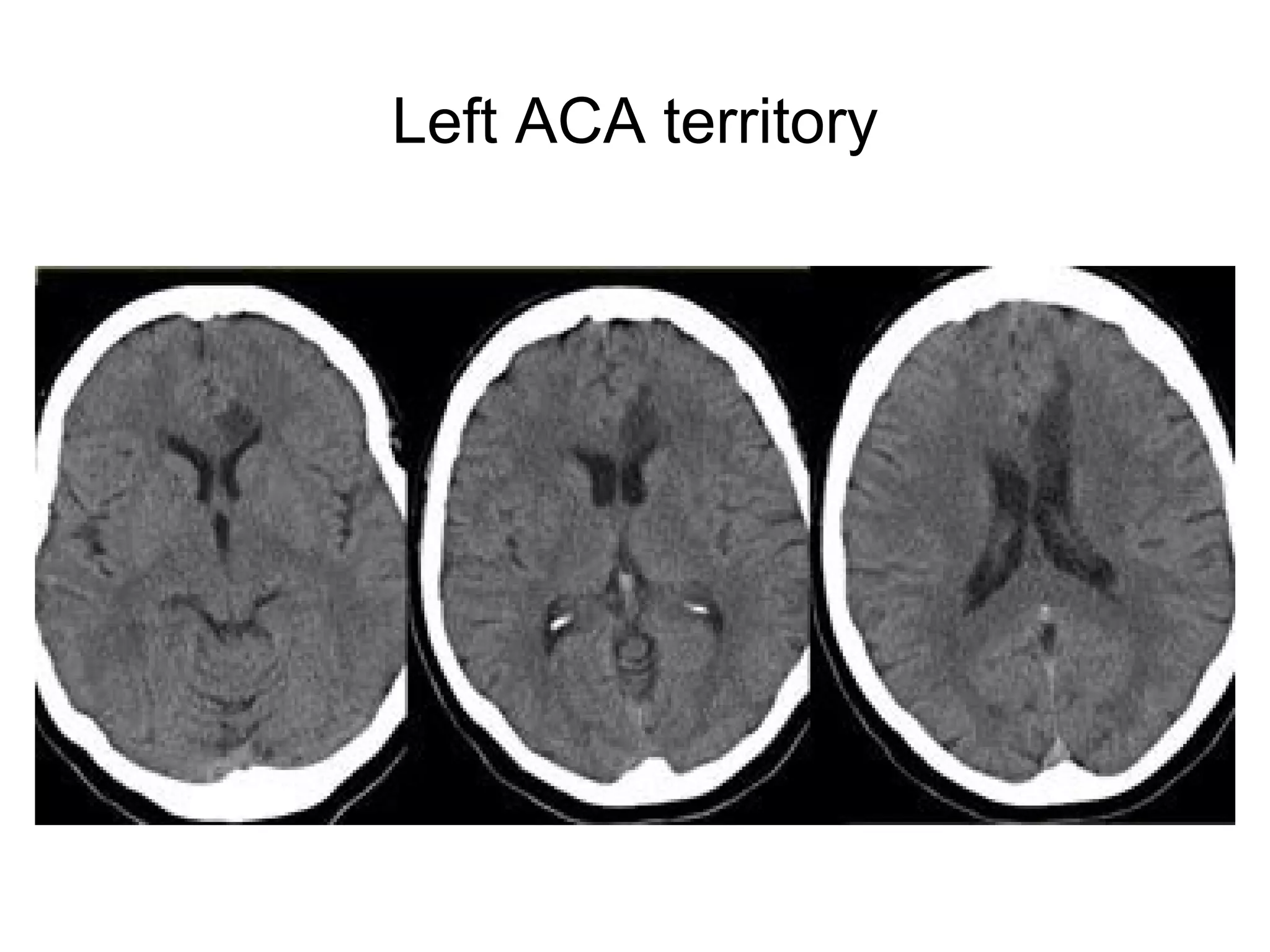 Imaging in acute stroke | PPT