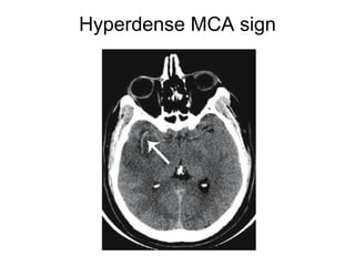 Imaging in acute stroke | PPT