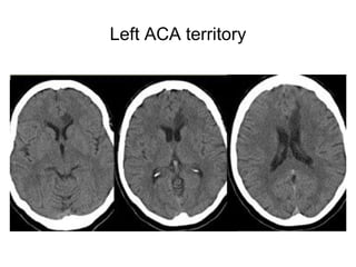 Imaging in acute stroke | PPT