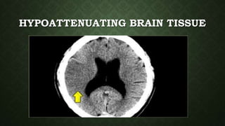 Imaging in acute stroke | PPTX