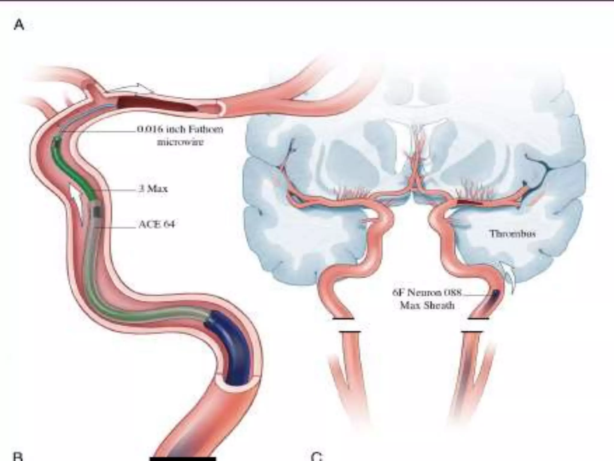 Imaging in acute stroke | PPTX