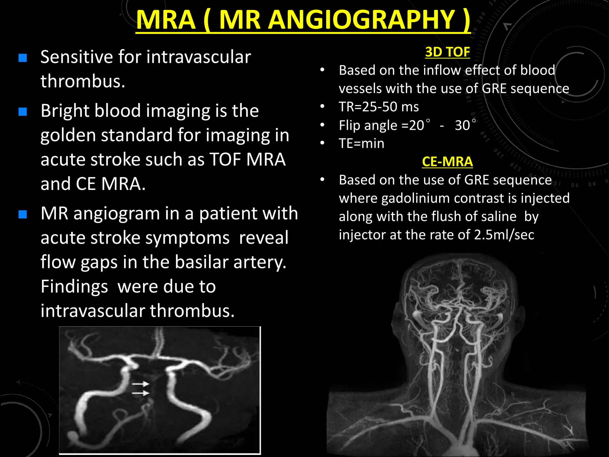 Imaging in acute stroke | PPTX