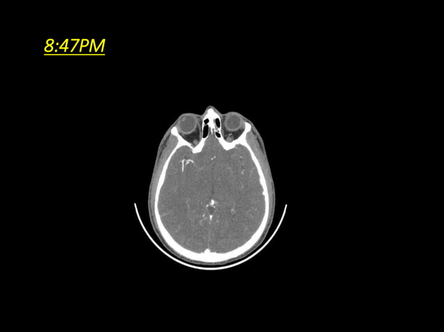 Imaging In Acute Stroke Ppt