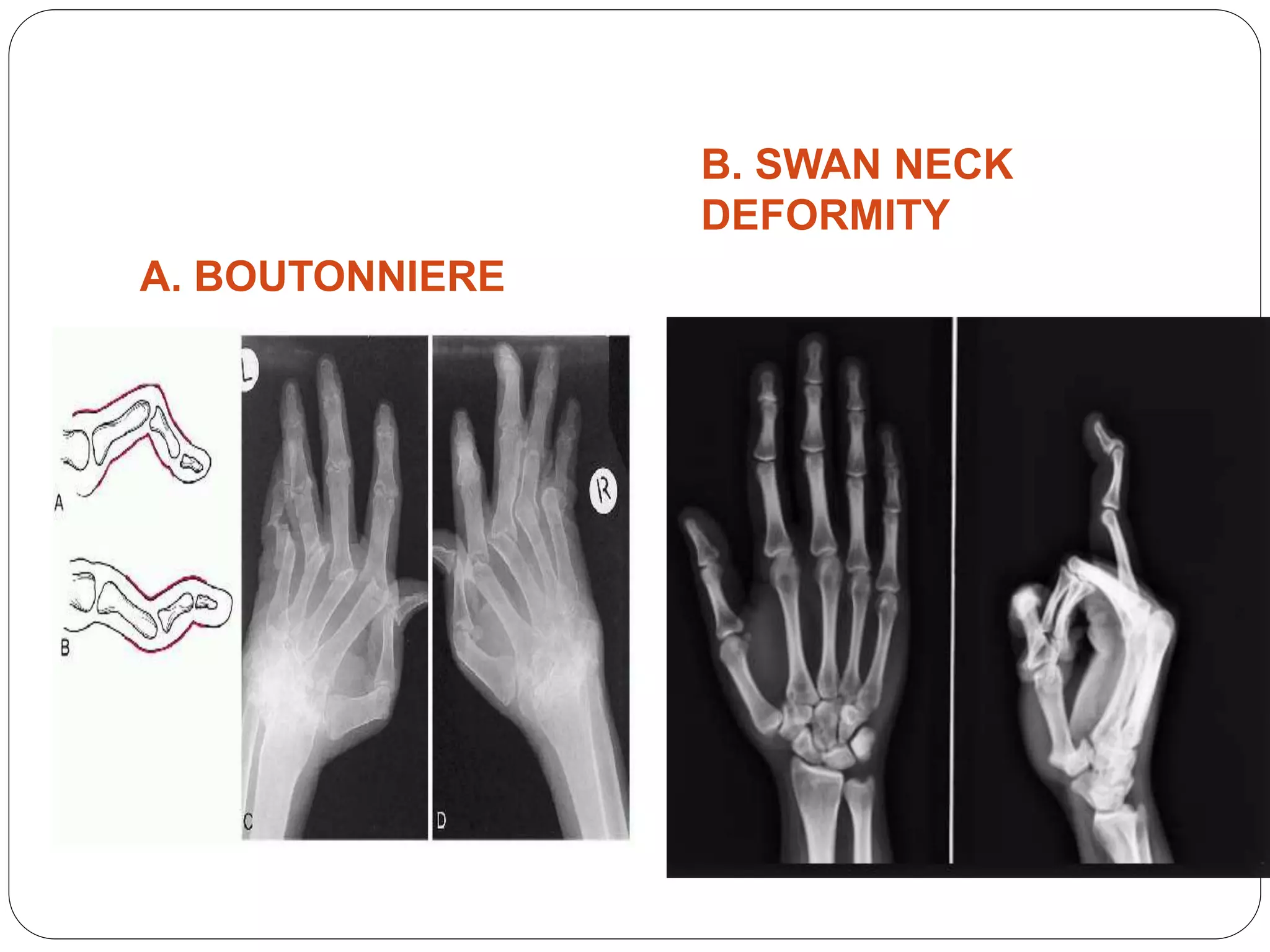 Imaging in arthritis | PPTX