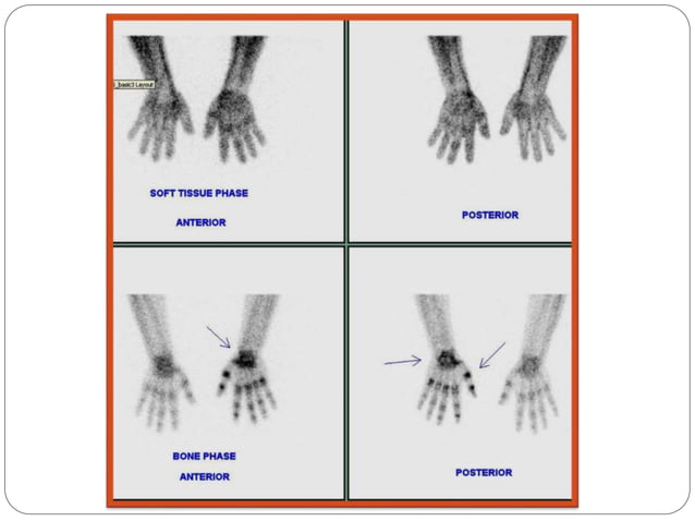 Imaging in arthritis | PPTX | Death, Injury, or Military Conflict ...