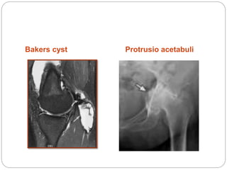 Imaging in arthritis | PPTX