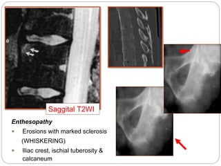 Imaging in arthritis | PPTX