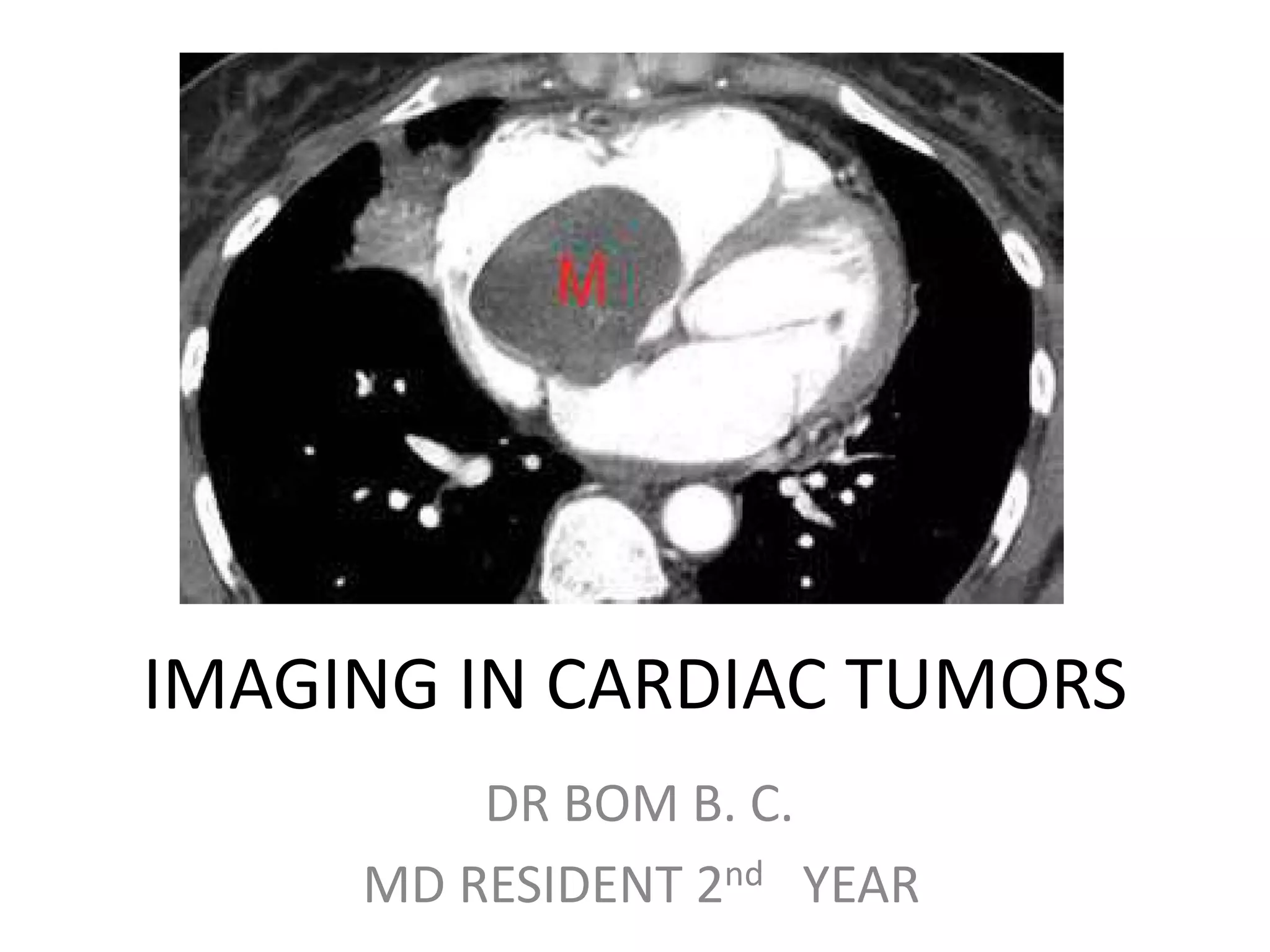 Imaging in Cardiac Tumours | PPTX