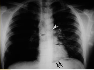 Imaging in chest trauma | PPT