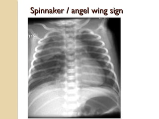 Imaging in chest trauma | PPT