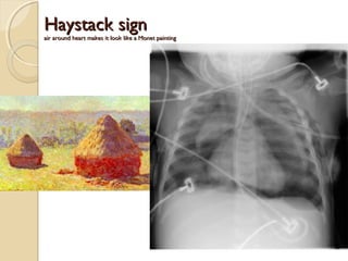 Imaging in chest trauma | PPT