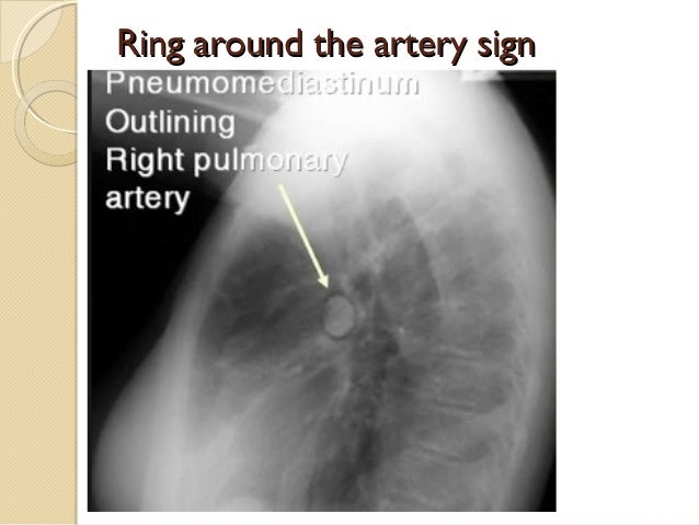 Imaging in chest trauma