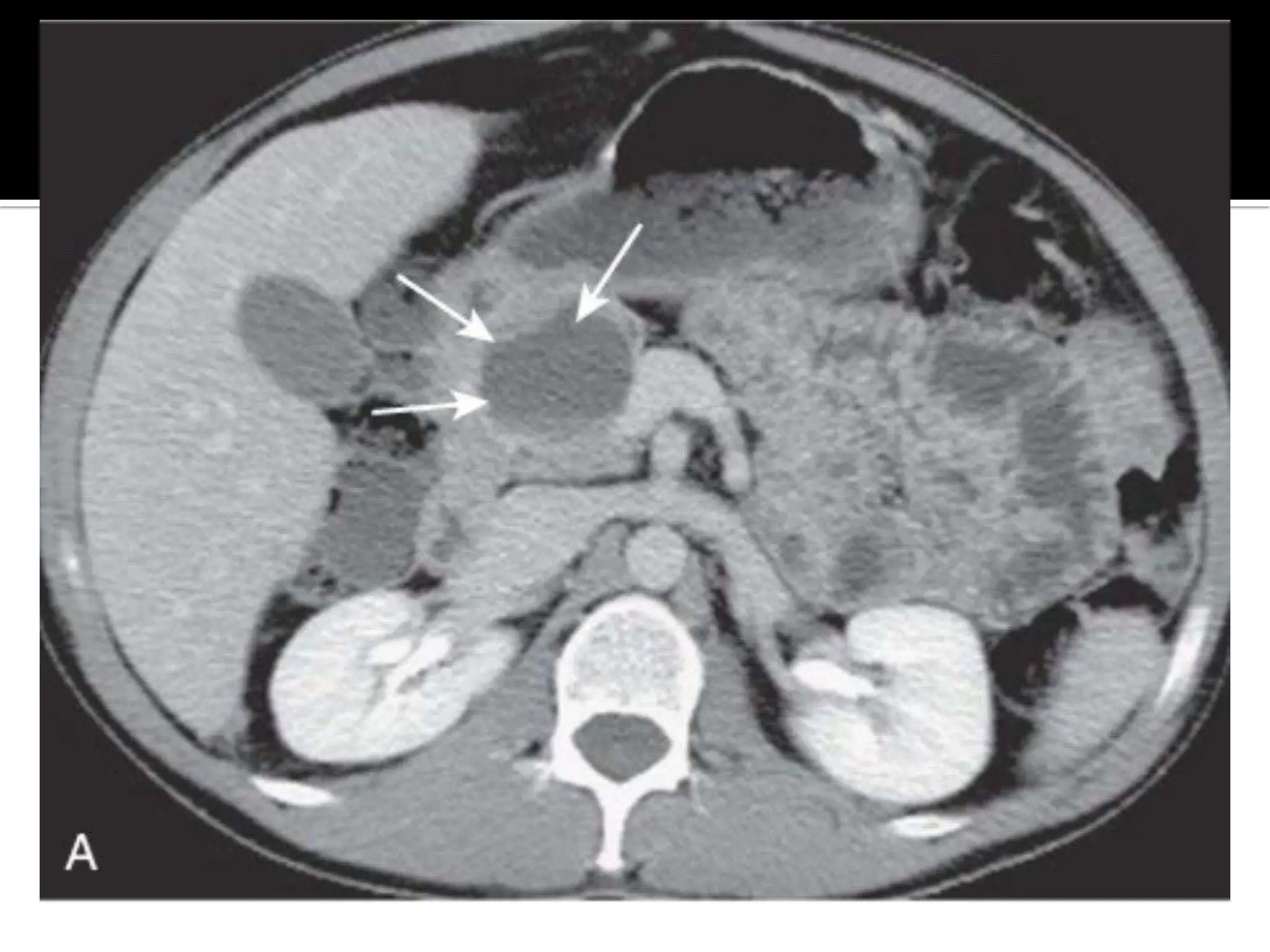 Imaging in cystic lesions of pancreas.pdf