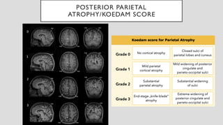 Imaging in Dementia - A Primer for neuroradiologists | PPTX