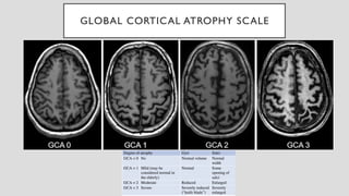 Imaging in Dementia - A Primer for neuroradiologists | PPTX