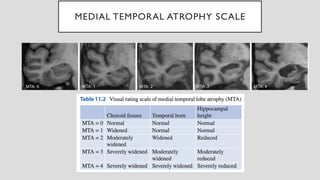 Imaging in Dementia - A Primer for neuroradiologists | PPTX