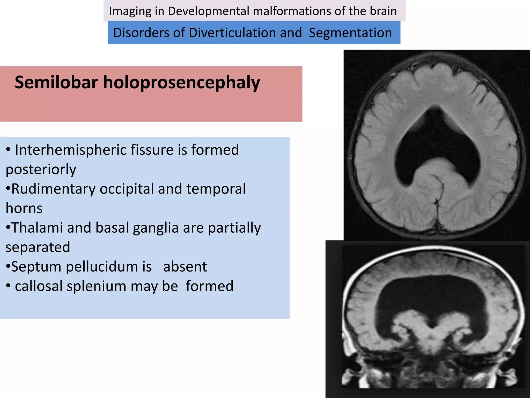 Imaging in developmental malformations of the brain | PPTX