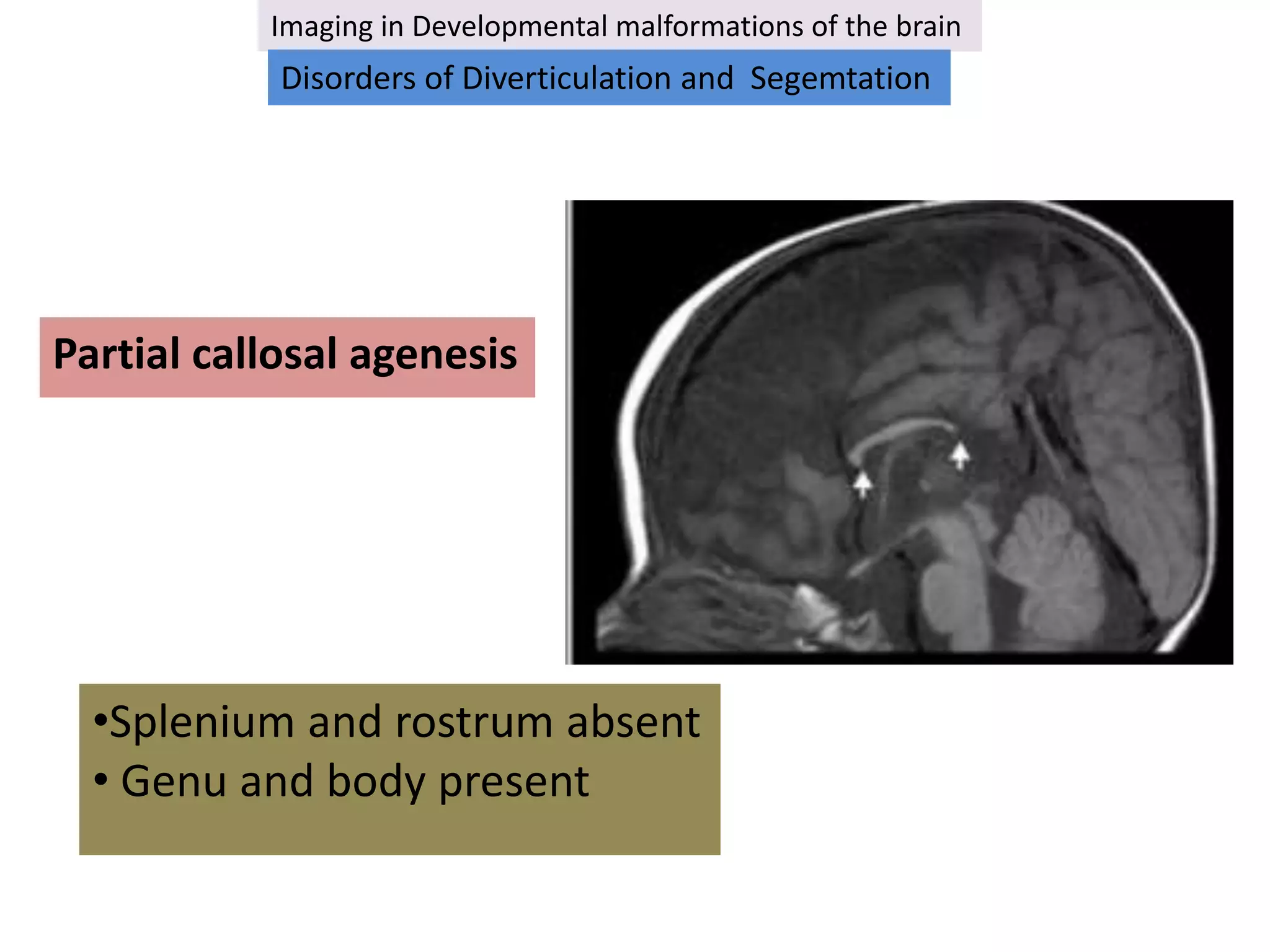 Imaging in developmental malformations of the brain | PPTX