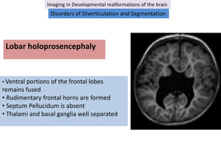 Imaging in developmental malformations of the brain | PPTX