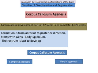 Imaging in developmental malformations of the brain | PPTX