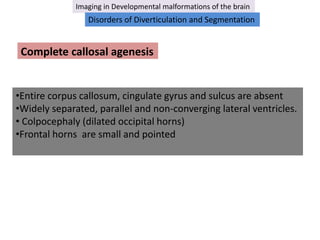 Imaging in developmental malformations of the brain | PPTX