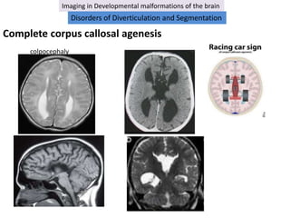 Imaging in developmental malformations of the brain | PPTX