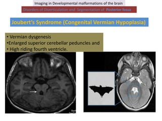 Imaging in developmental malformations of the brain | PPTX