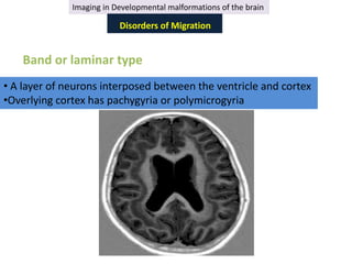 Imaging in developmental malformations of the brain | PPTX