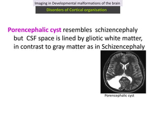Imaging in developmental malformations of the brain | PPTX