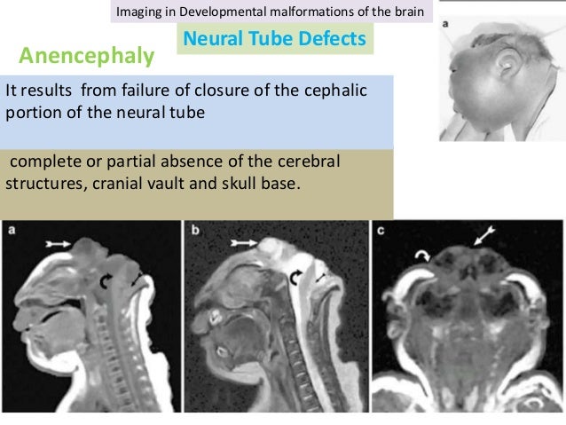 Imaging in developmental malformations of the brain