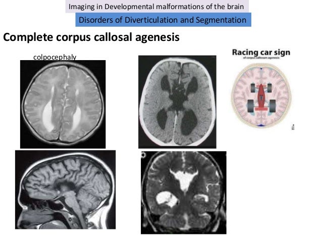 Imaging in developmental malformations of the brain