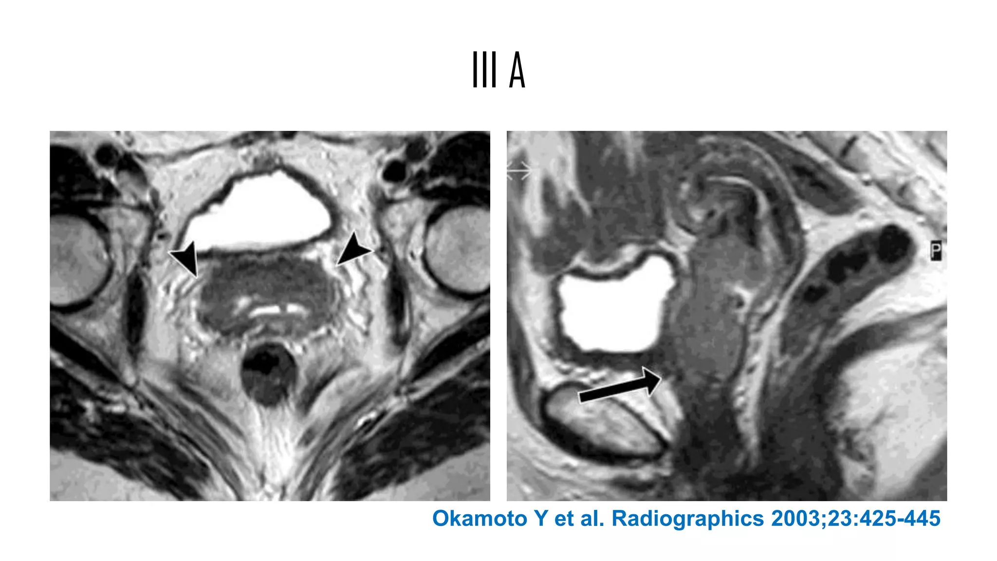 Imaging in diagnosis and treatment of carcinoma cervix | PPTX