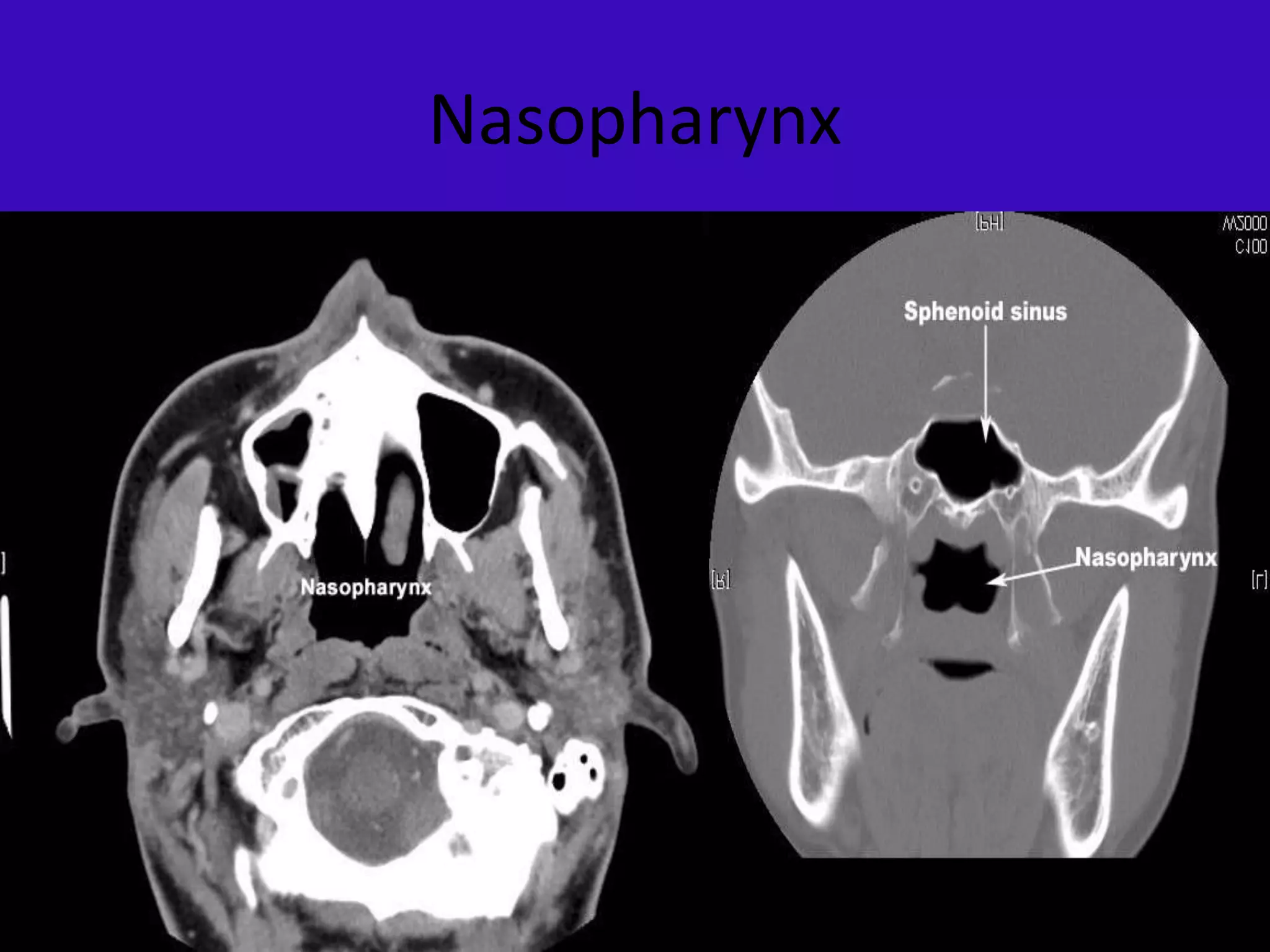 Imaging in ent | PPTX | Ear, Nose and Throat Conditions | Diseases and ...