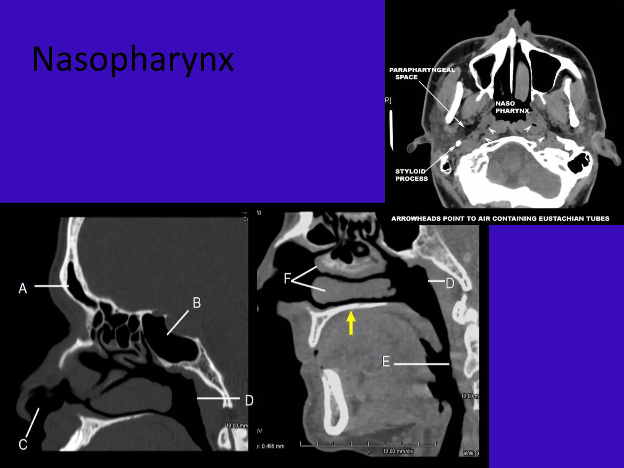 Imaging in ent | PPTX | Ear, Nose and Throat Conditions | Diseases and ...