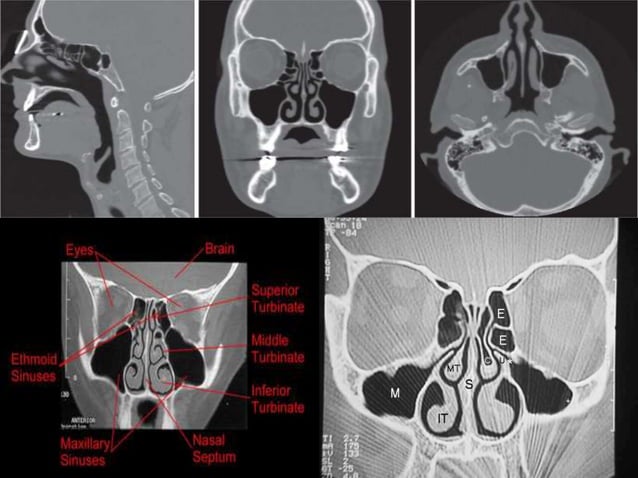 Imaging in ent | PPTX | Ear, Nose and Throat Conditions | Diseases and ...