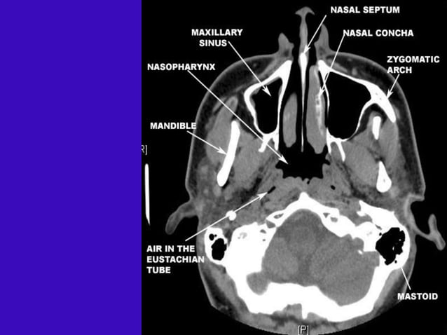 Imaging in ent | PPTX | Ear, Nose and Throat Conditions | Diseases and ...